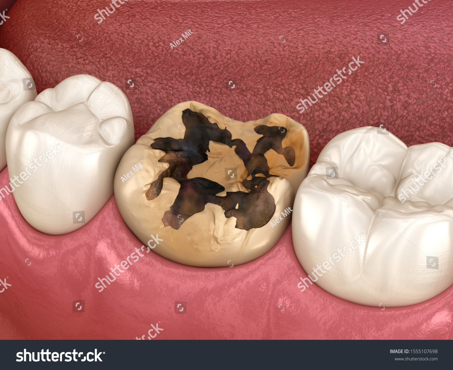 Caries Removing Process Medically Accurate Tooth Stock Illustration ... Caries Removing Process Medically Accurate Tooth Stock Illustration ...