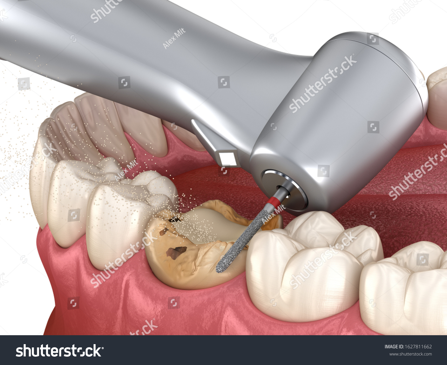 Caries Removing Process Medically Accurate Tooth 库存插图 1627811662 ... Caries Removing Process Medically Accurate Tooth 库存插图 1627811662 ...