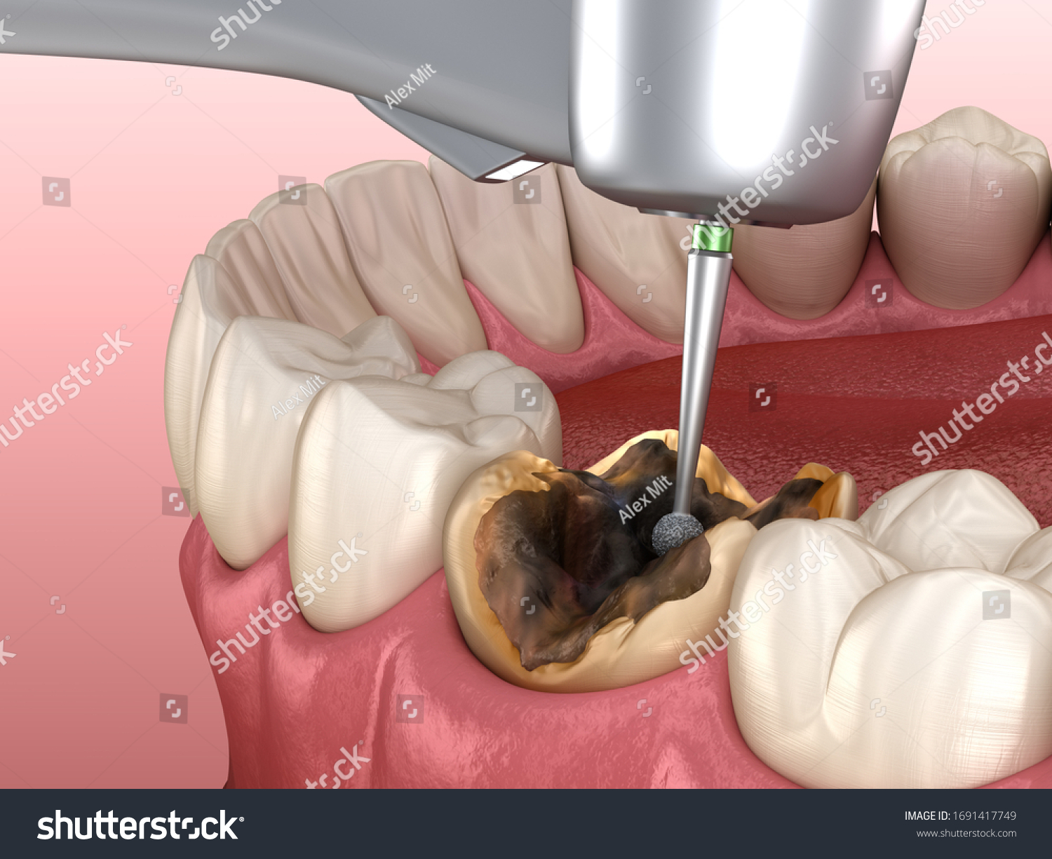 Caries Removing Process Medically Accurate Tooth 库存插图 1691417749 ... Caries Removing Process Medically Accurate Tooth 库存插图 1691417749 ...