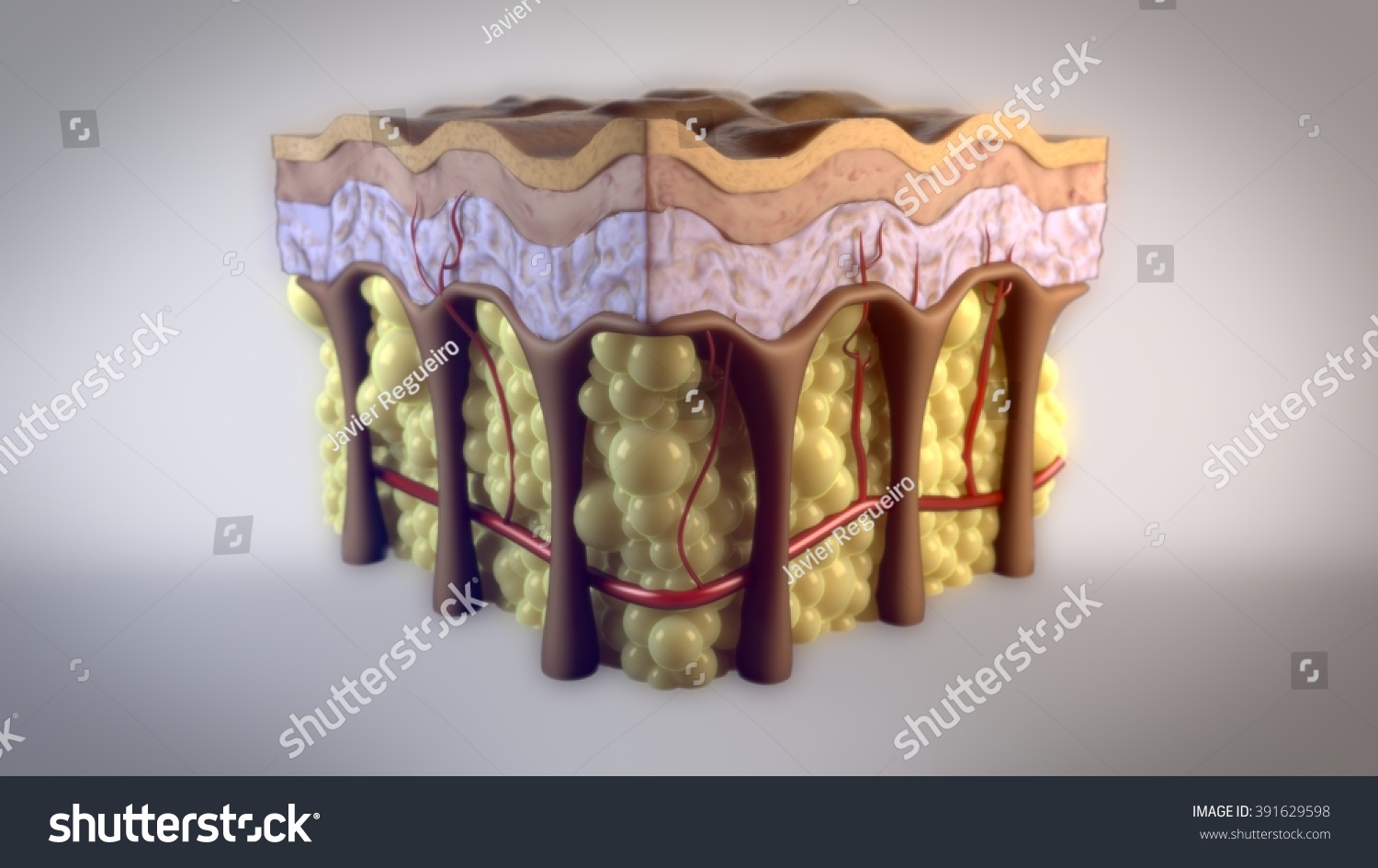Cellulitis Stock Illustration 391629598 | Shutterstock