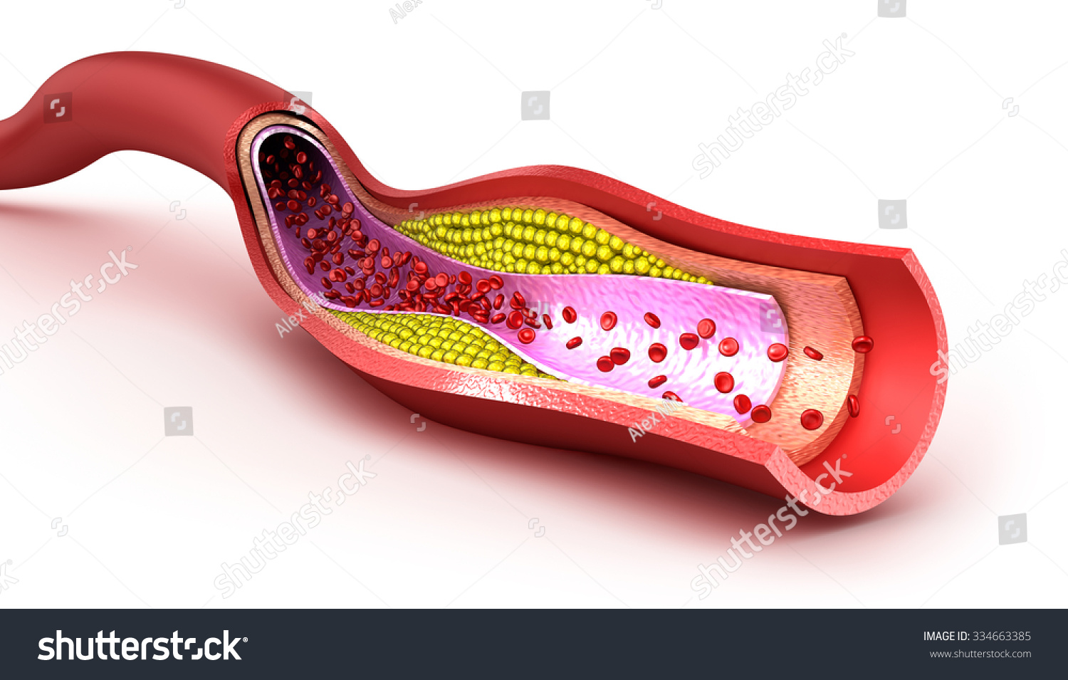 Cholesterol Plaque Blood Vessel Illustration Stock Illustration ... Cholesterol Plaque Blood Vessel Illustration Stock Illustration ...
