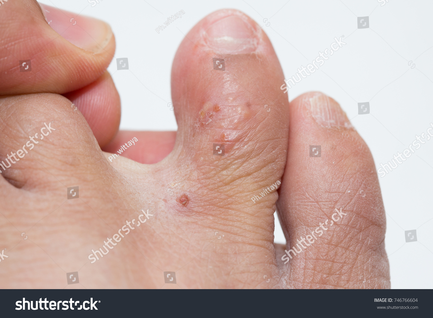 Closeup Foot Dyshidrotic Eczema Isolated White Photo De Stock Modifiable 746766604