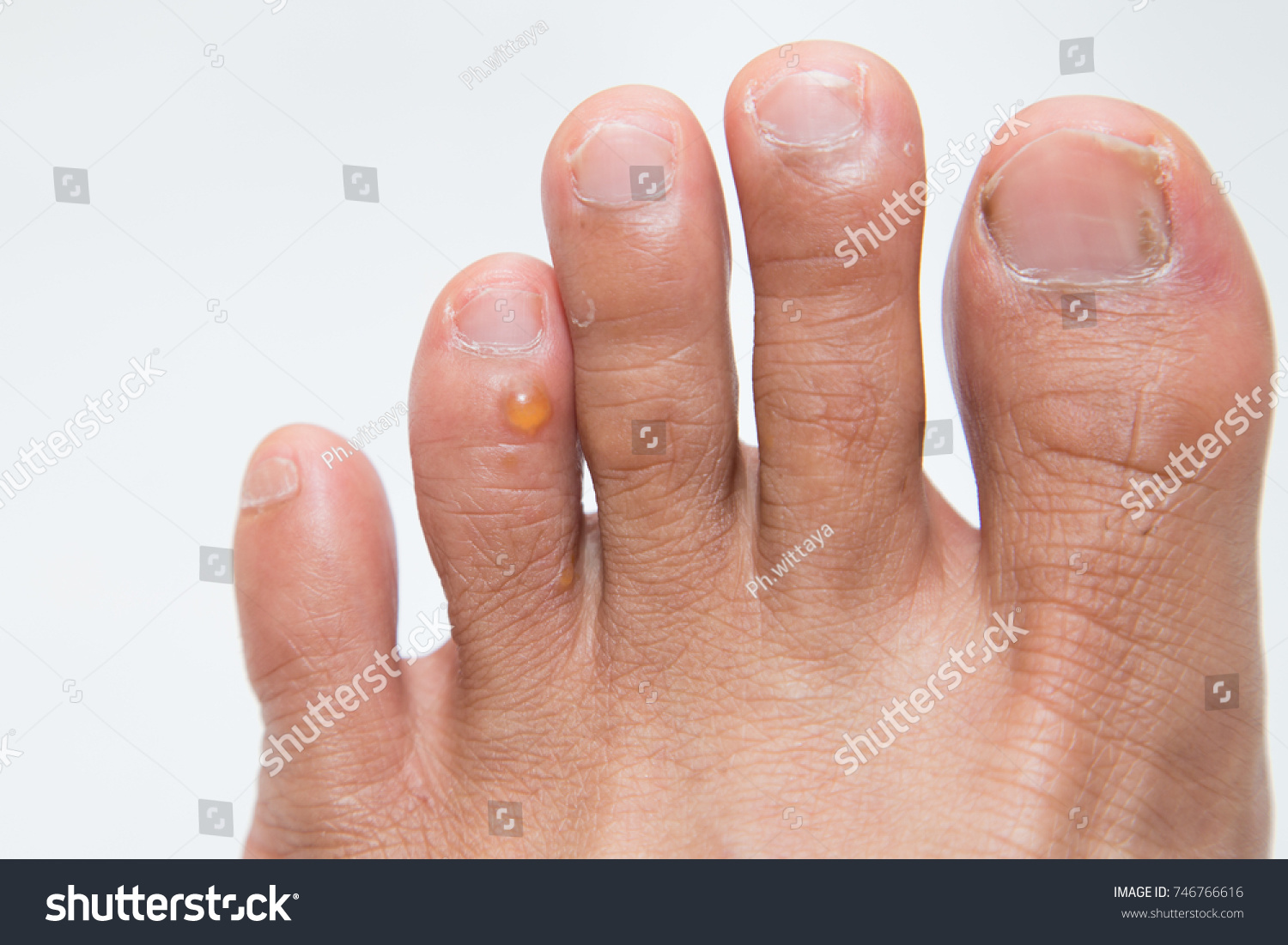 Closeup Foot Dyshidrotic Eczema Isolated White Stockfoto 746766616 Shutterstock