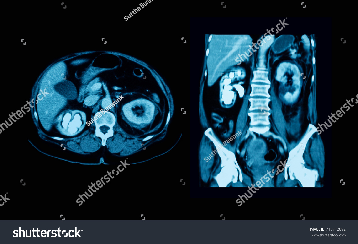 Ct Scan Computed Tomography Abdominal Urinary Foto stock 716712892 ... Ct Scan Computed Tomography Abdominal Urinary Foto stock 716712892 ...