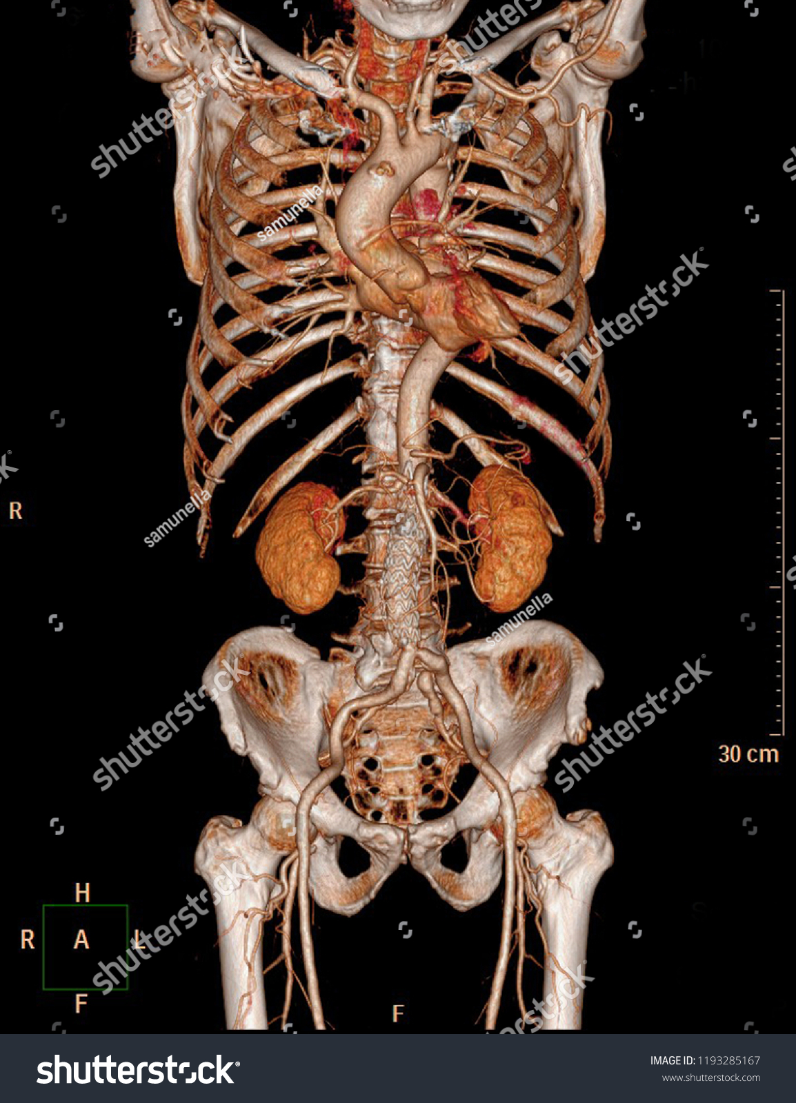 Cta Whole Aorta Ct Angiography 3d 스톡 일러스트 1193285167 Shutterstock