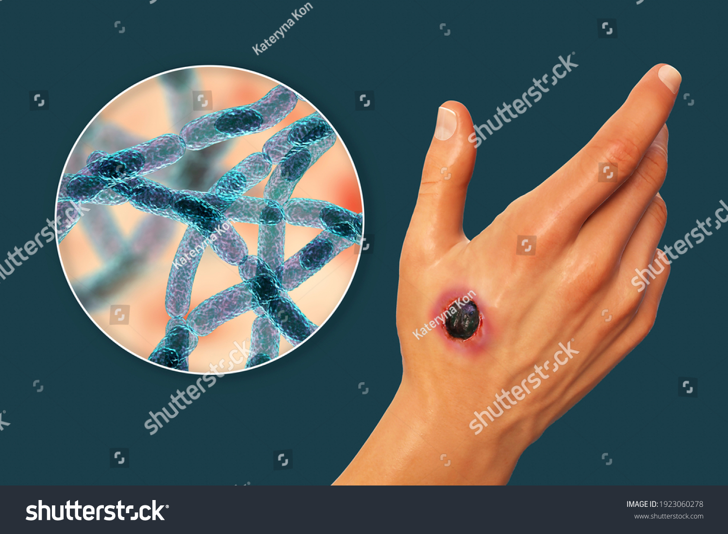 Cutaneous Anthrax Most Common Form Anthrax 库存插图 1923060278 | Shutterstock Cutaneous Anthrax Most Common Form Anthrax 库存插图 1923060278 | Shutterstock