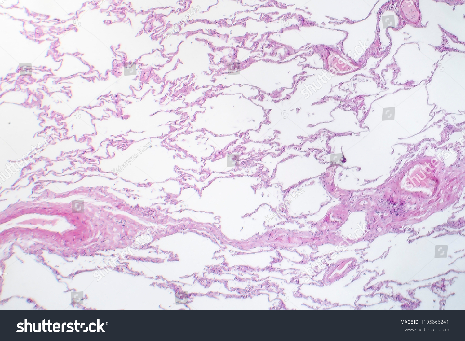 Diffuse Lung Emphysema Light Micrograph Photo Stock Photo (Edit Now ...