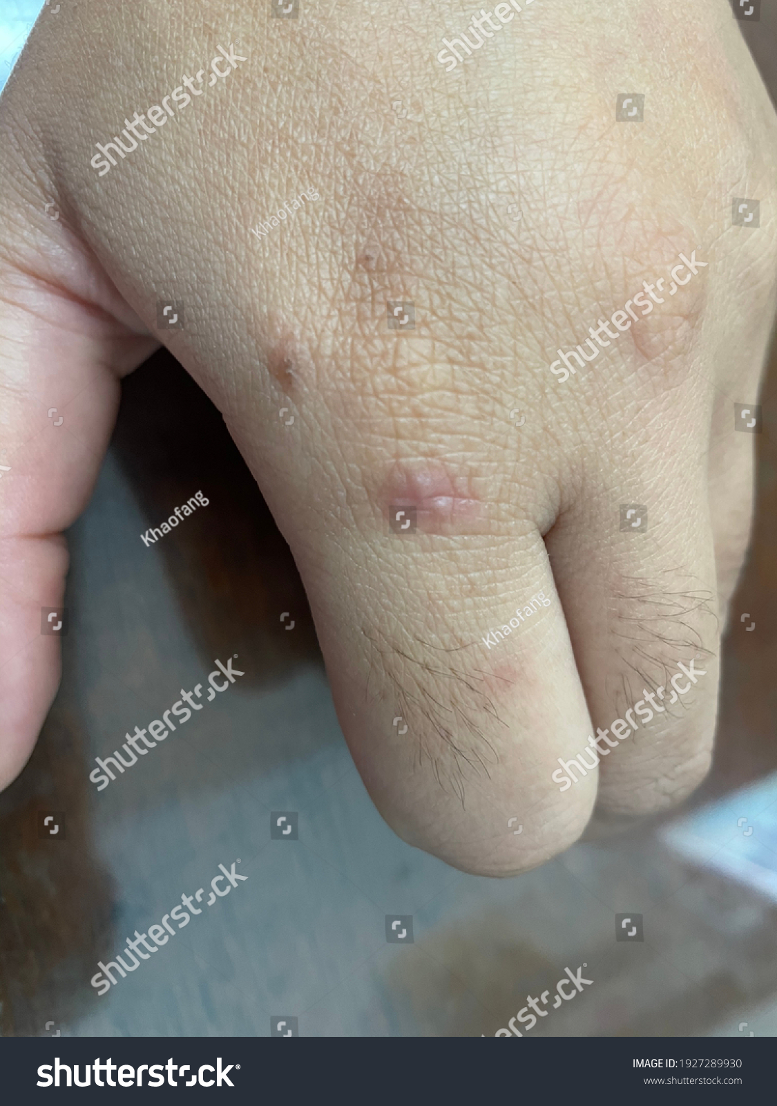 Dyshidrosis Dyshidrotic Eczema Pompholyx Endrogenous Dermatitis Foto Stock 1927289930 Shutterstock