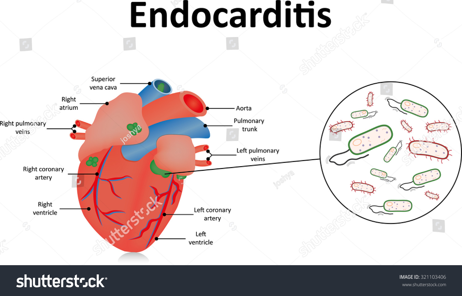 Endocarditis Stock Illustration 321103406