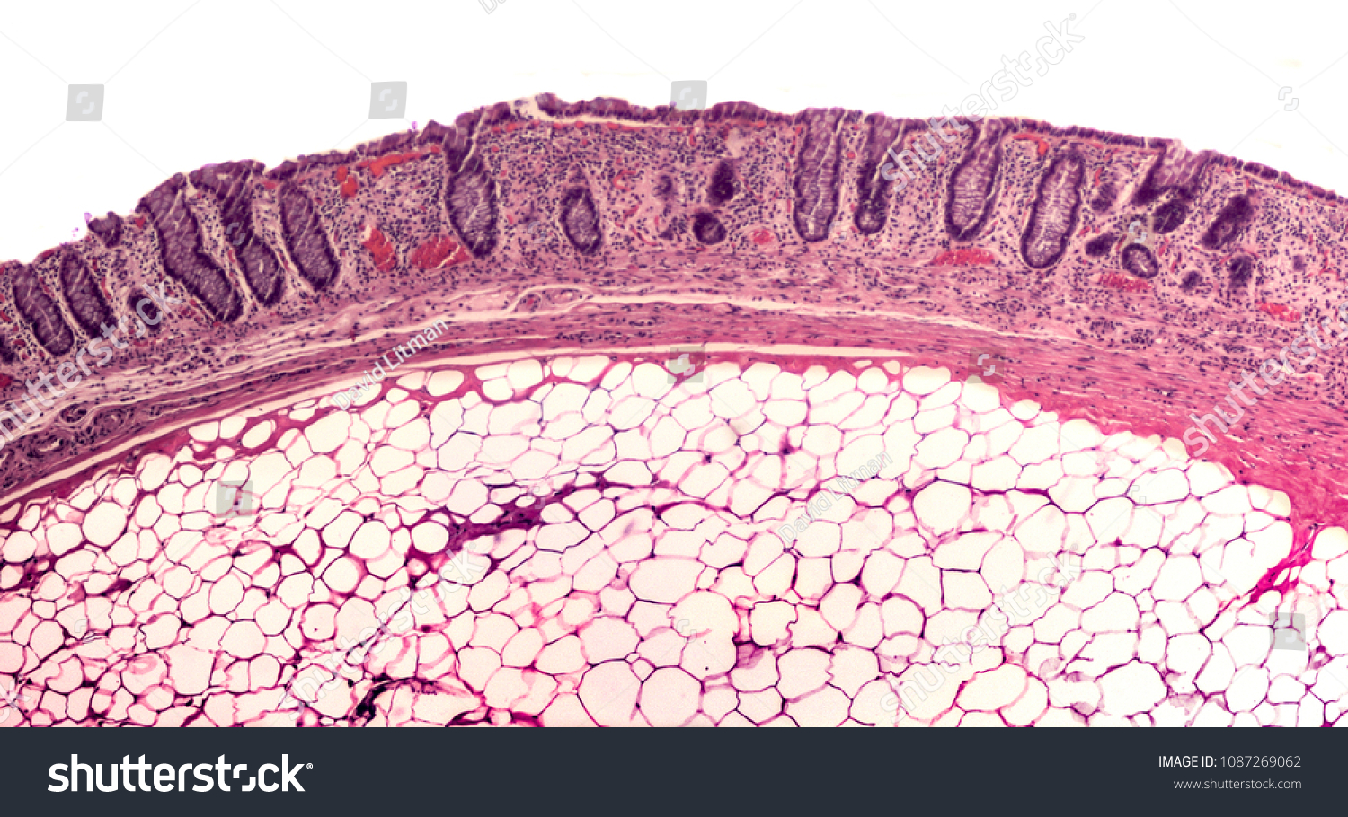 Endoscopic Biopsy Showing Submucosal Lipoma Colon库存照片1087269062 ... Endoscopic Biopsy Showing Submucosal Lipoma Colon库存照片1087269062 ...