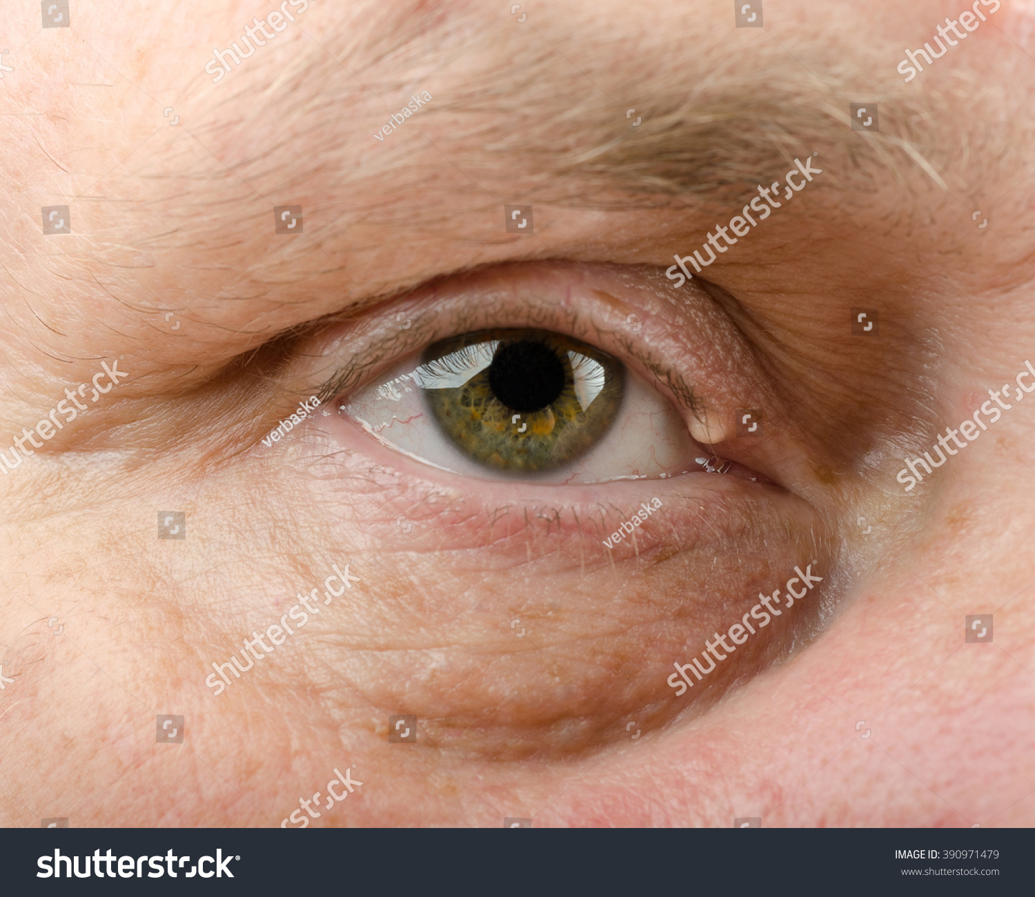 Meibomian Cyst 16 Images Photos Et Images Vectorielles De Stock