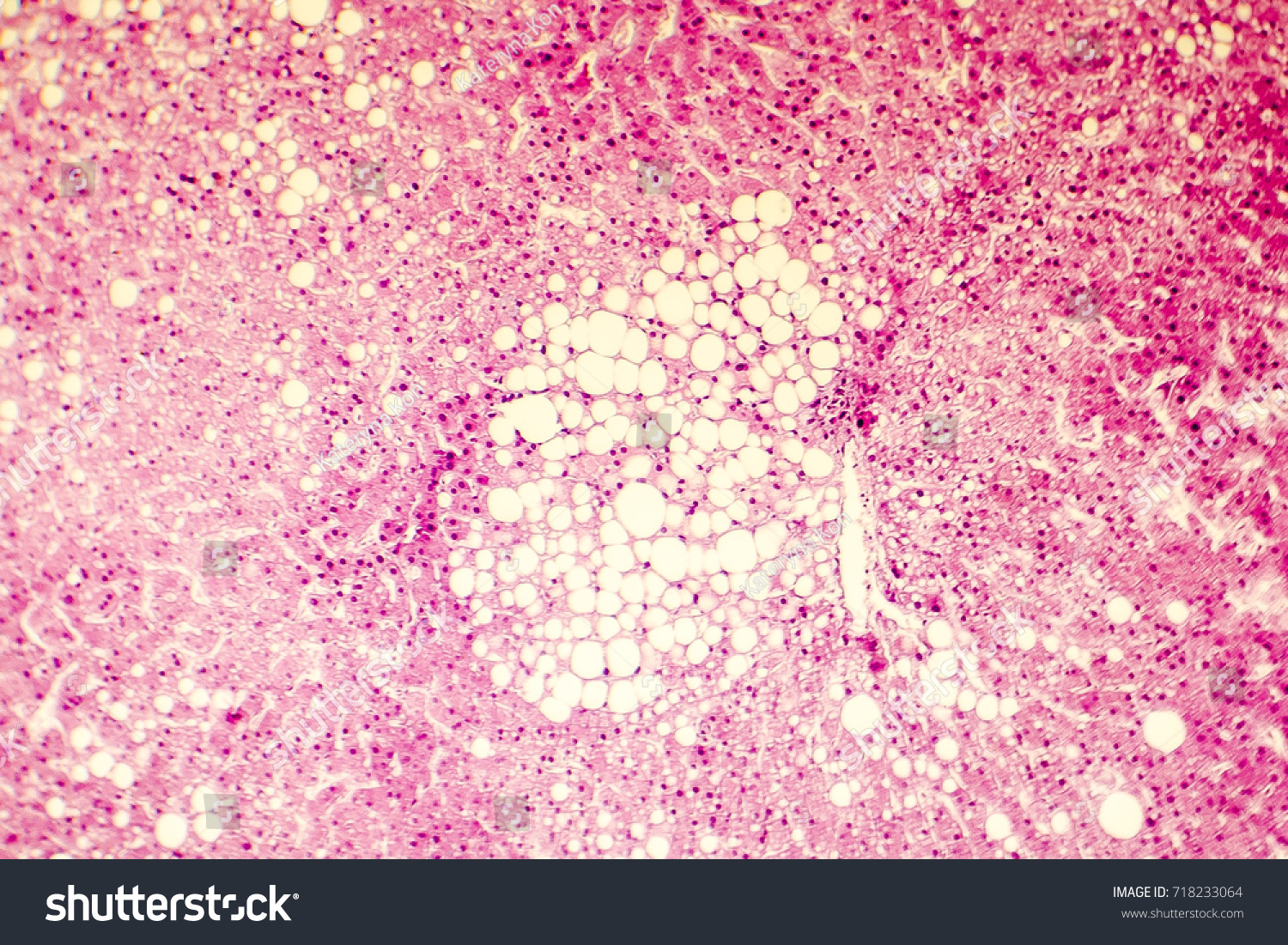 Fatty Liver Liver Steatosis Photomicrograph Showing Foto Stok 718233064 ... Fatty Liver Liver Steatosis Photomicrograph Showing Foto Stok 718233064 ...