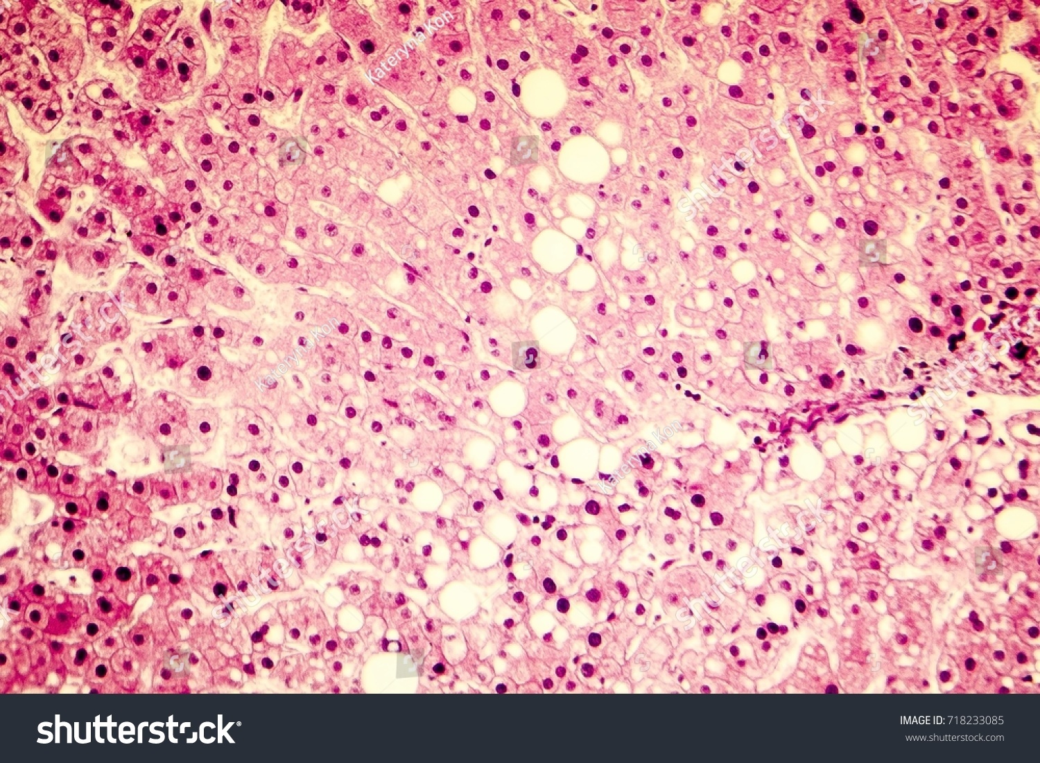 Fatty Liver Liver Steatosis Photomicrograph Showing Stock Photo (Edit ... Fatty Liver Liver Steatosis Photomicrograph Showing Stock Photo (Edit ...