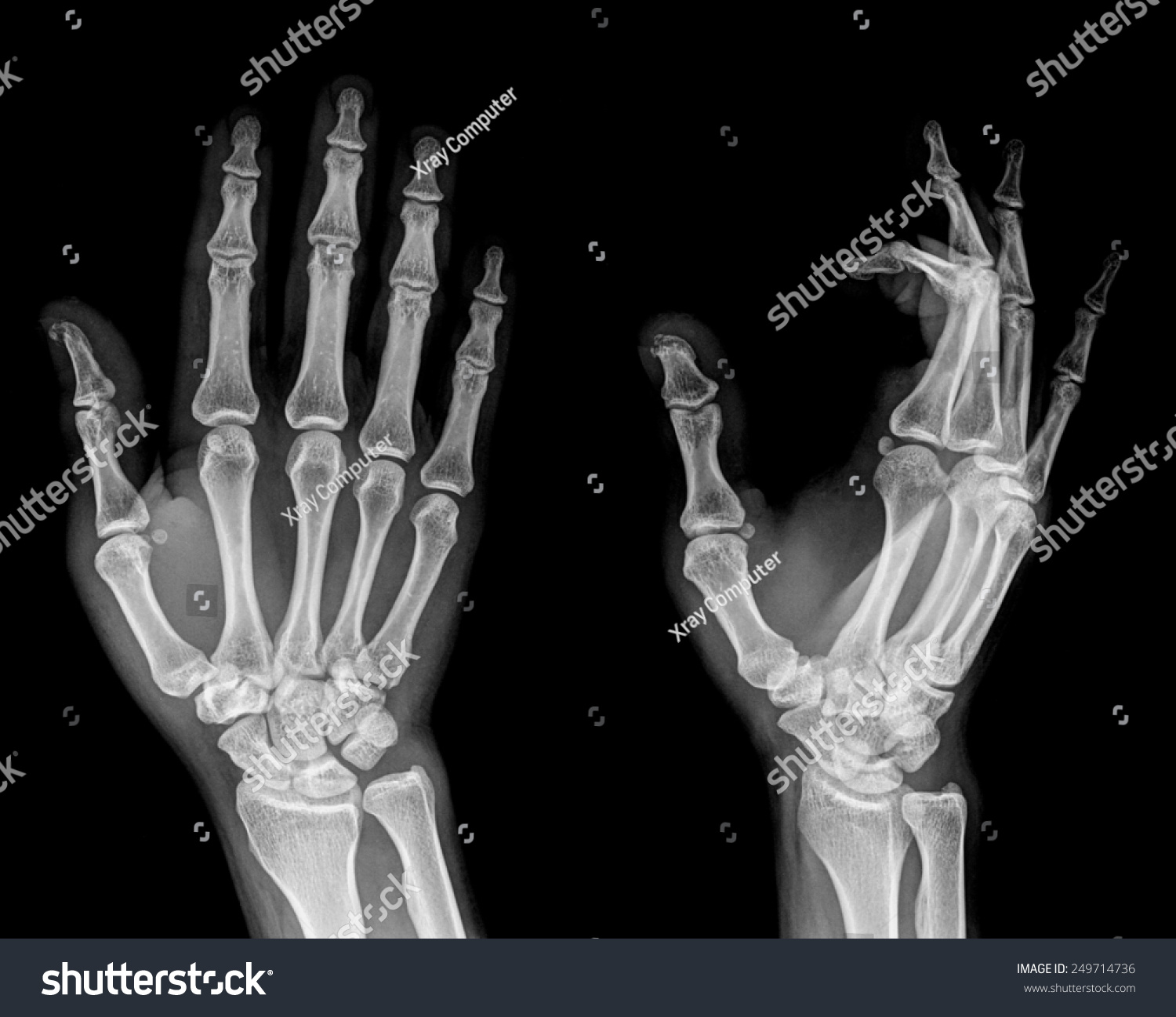 Film Xray Both Hand Ap Show 스톡 사진 지금 편집 249714736