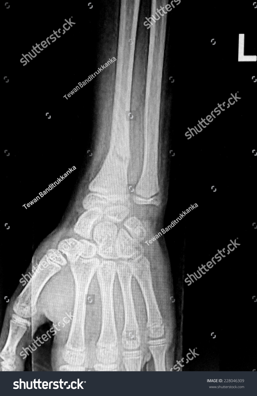 Film Xray Wrist Show Fracture Stock Photo (Edit Now) 228046309 Film Xray Wrist Show Fracture Stock Photo (Edit Now) 228046309