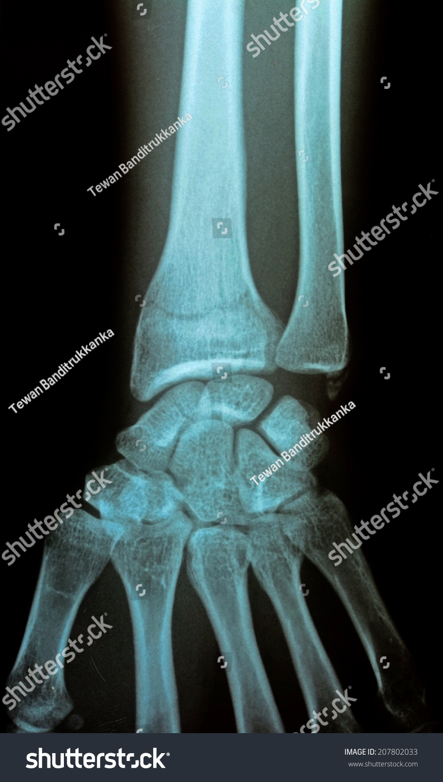 Film Xray Wrist Show Fracture Distal Stock Photo (Edit Now) 207802033 Film Xray Wrist Show Fracture Distal Stock Photo (Edit Now) 207802033