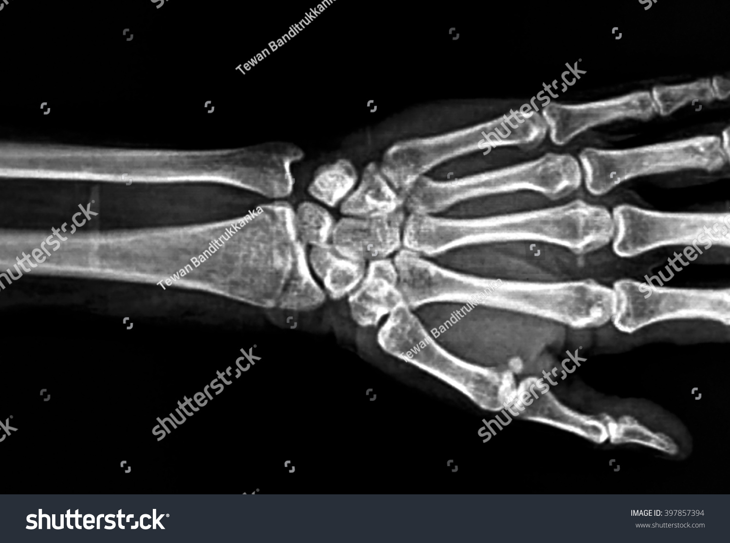 Film Xray Wrist Show Fracture Distal Stock Photo 397857394 | Shutterstock Film Xray Wrist Show Fracture Distal Stock Photo 397857394 | Shutterstock
