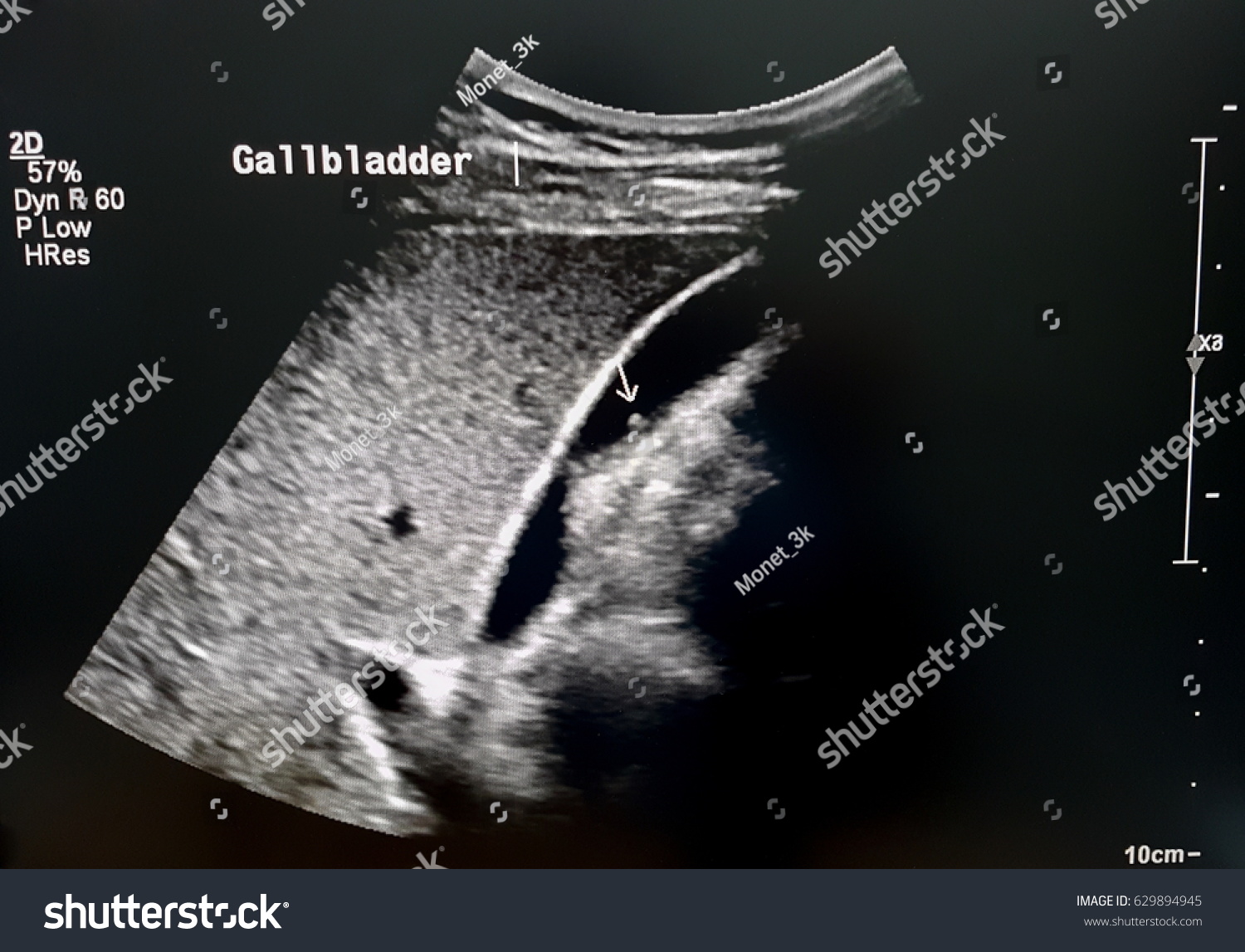 Gallbladder Polyp Stock Photo 629894945 | Shutterstock