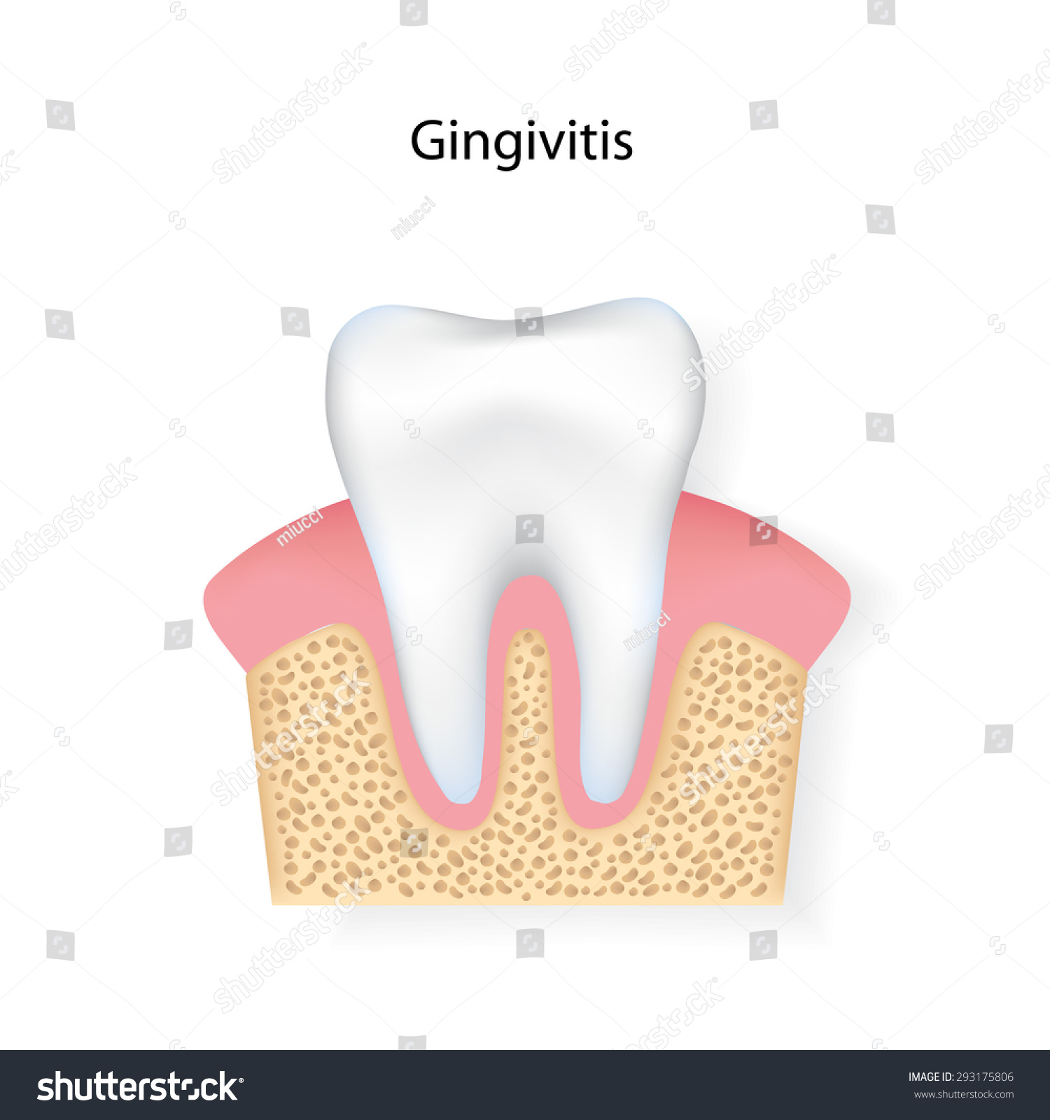 Gingivitis Stock Illustration 293175806