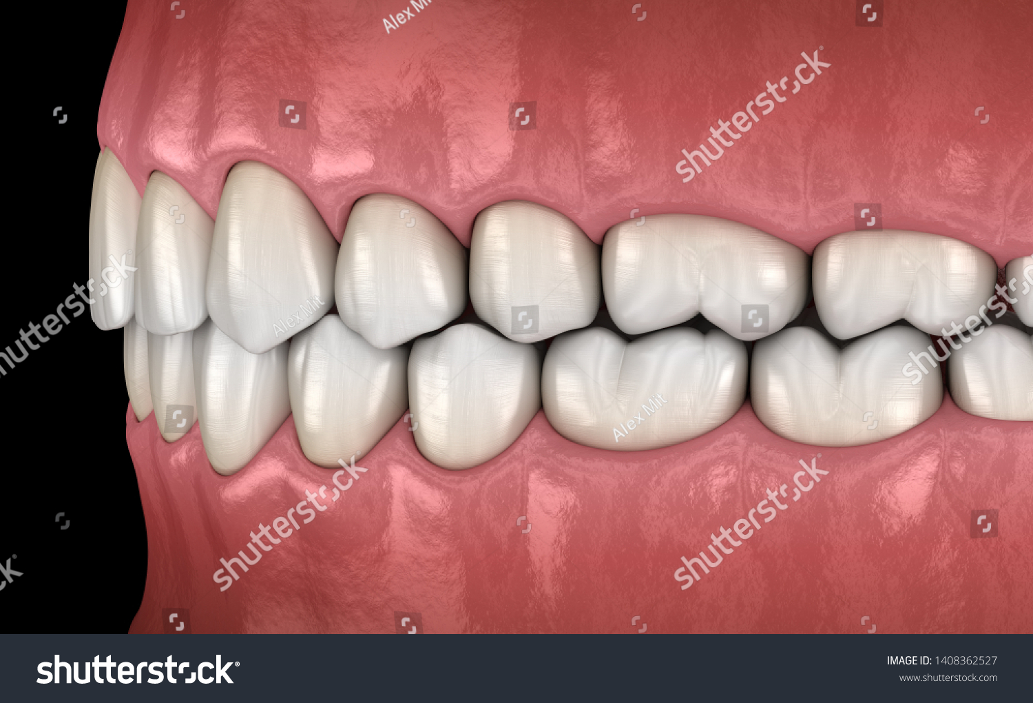 Healthy Human Teeth Normal Occlusion Side Stock Illustration 1408362527 ... Healthy Human Teeth Normal Occlusion Side Stock Illustration 1408362527 ...