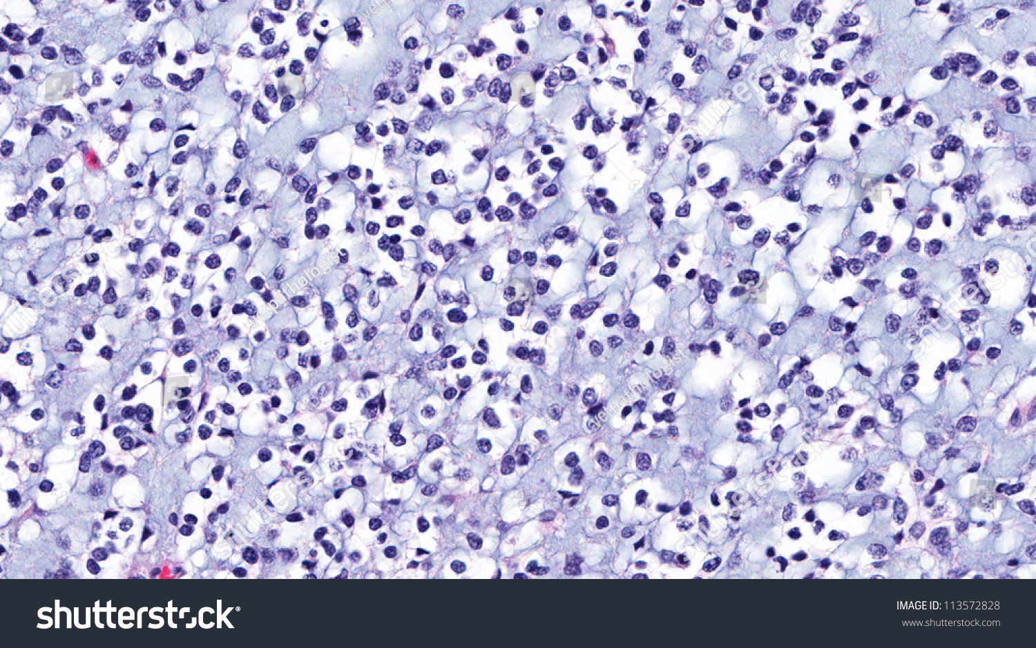 Highly Magnified View Brain Tumor Oligodendroglioma Stock Photo ... Highly Magnified View Brain Tumor Oligodendroglioma Stock Photo ...