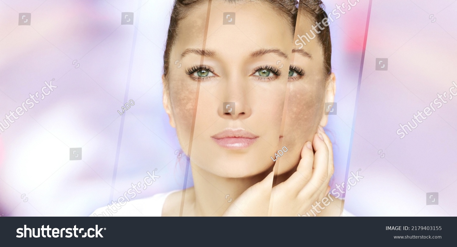 Hyperpigmentation Chloasma Melasma Age Spotspostinflammatory ...