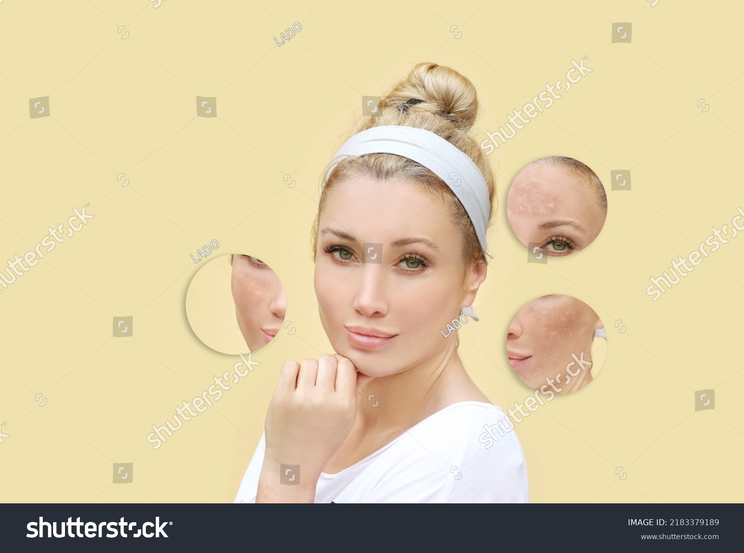 Hyperpigmentation Chloasma Melasma Age Spotspostinflammatory ...