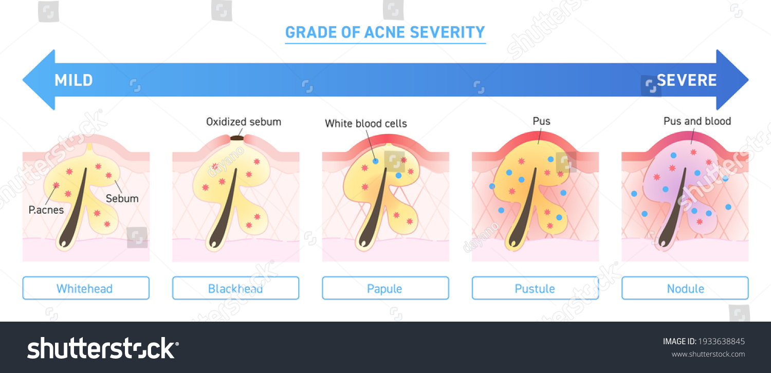 Illustration Grade Acne Severity Stock Illustration 1933638845 ... Illustration Grade Acne Severity Stock Illustration 1933638845 ...