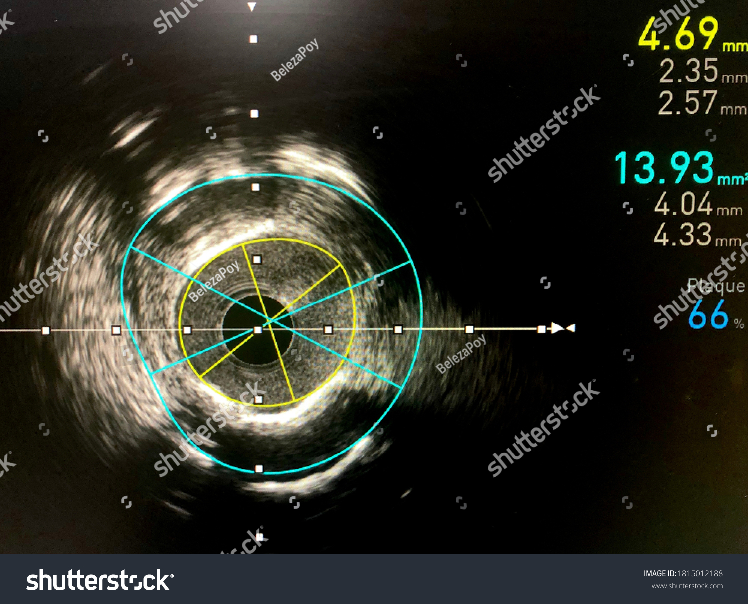 Intravascular Ultrasound Imaging Ivus Performed Crosssectional Stock