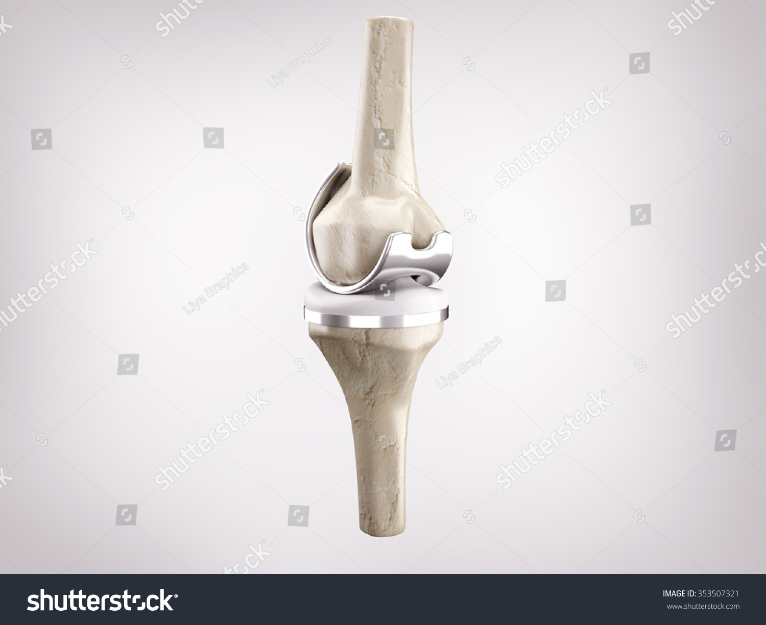 946 Knee prosthesis Stock Illustrations, Images & Vectors | Shutterstock