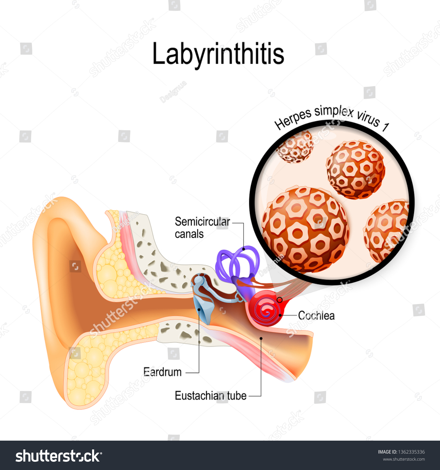 Ilustrasi Stok Labyrinthitis Vestibular Neuritis Inflammation Inner Ear ... Ilustrasi Stok Labyrinthitis Vestibular Neuritis Inflammation Inner Ear ...