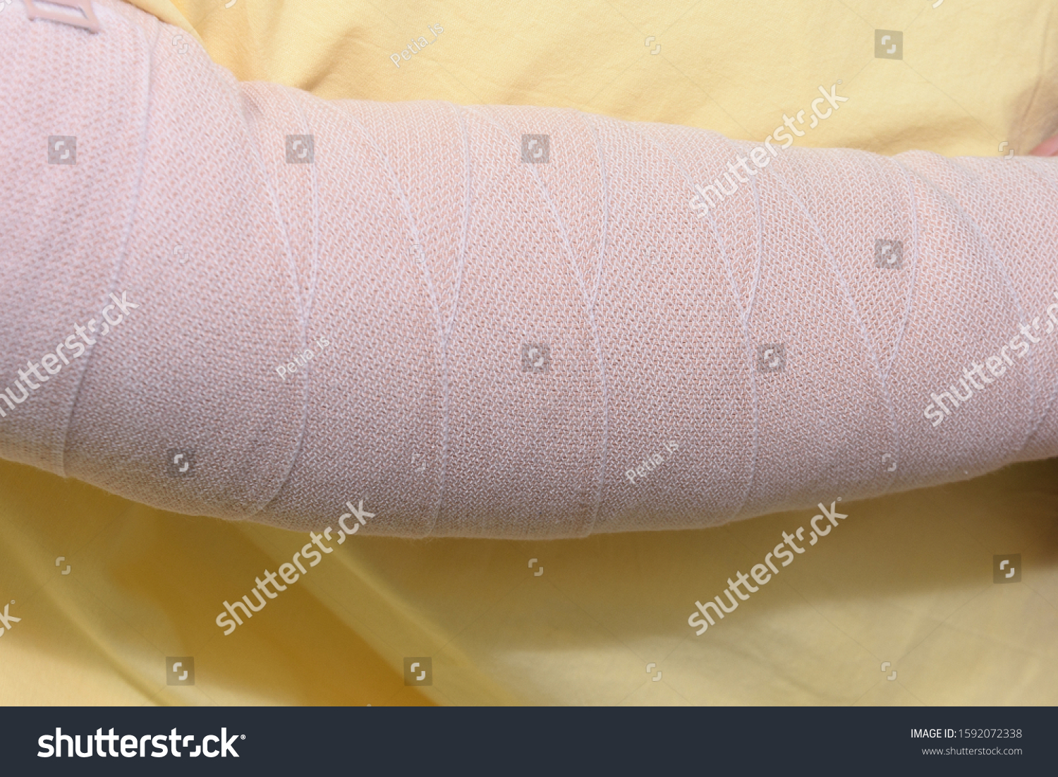 Zdjęcie Stockowe „lymphedema Management Wrapping Lymphedema Hand Arm” 1592072338 Shutterstock
