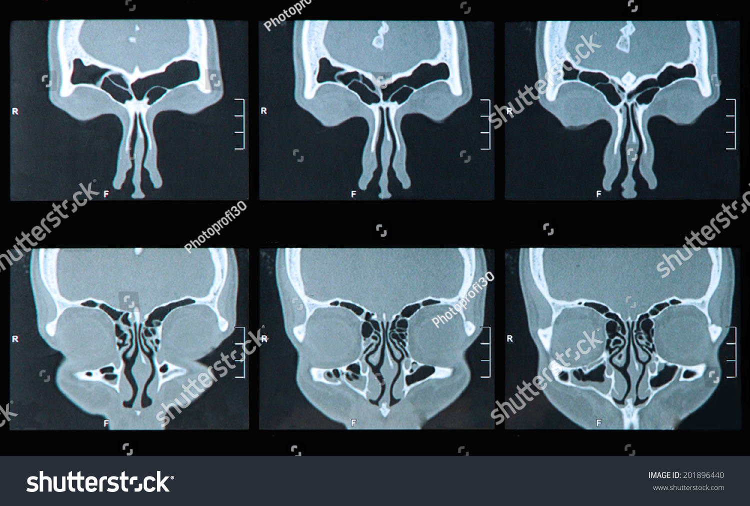 Mri Scan Human Sinus Nasal Passages Fotka 201896440 Shutterstock