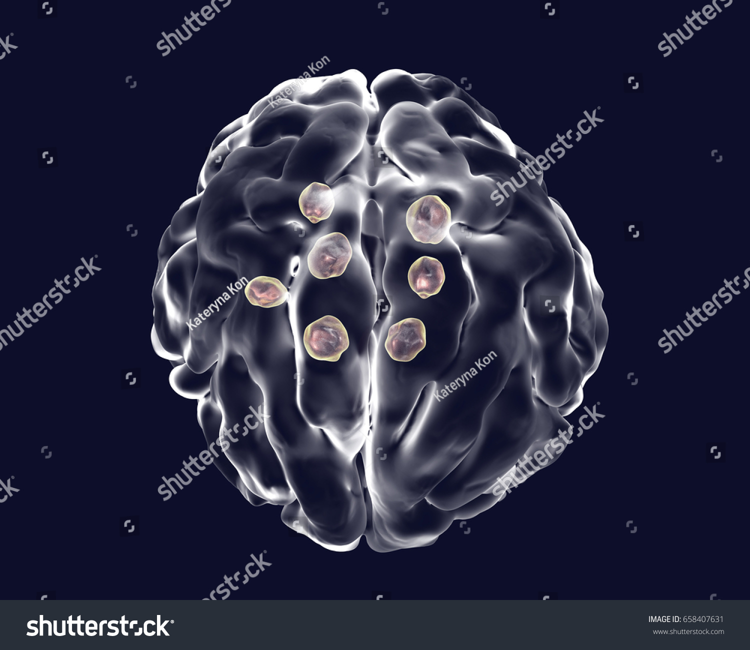 Multiple Cryptococcal Cysts Brain Cryptococcoma 3d Stock Illustration ...
