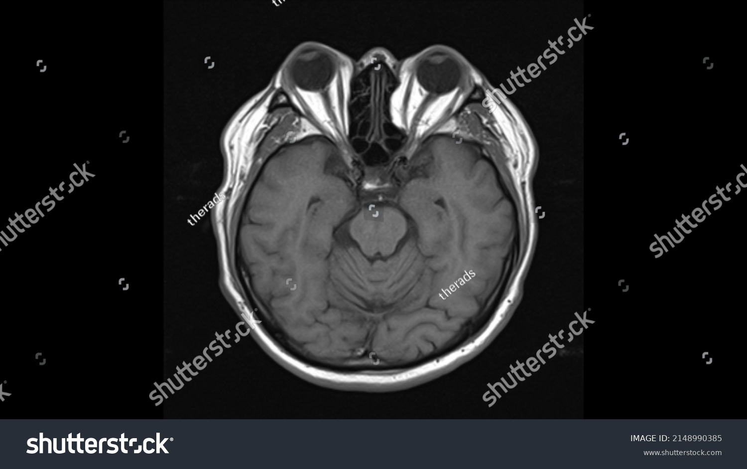 Normal Brain Anatomy Axial T1weighted Mri Stock Photo 2148990385 ... Normal Brain Anatomy Axial T1weighted Mri Stock Photo 2148990385 ...