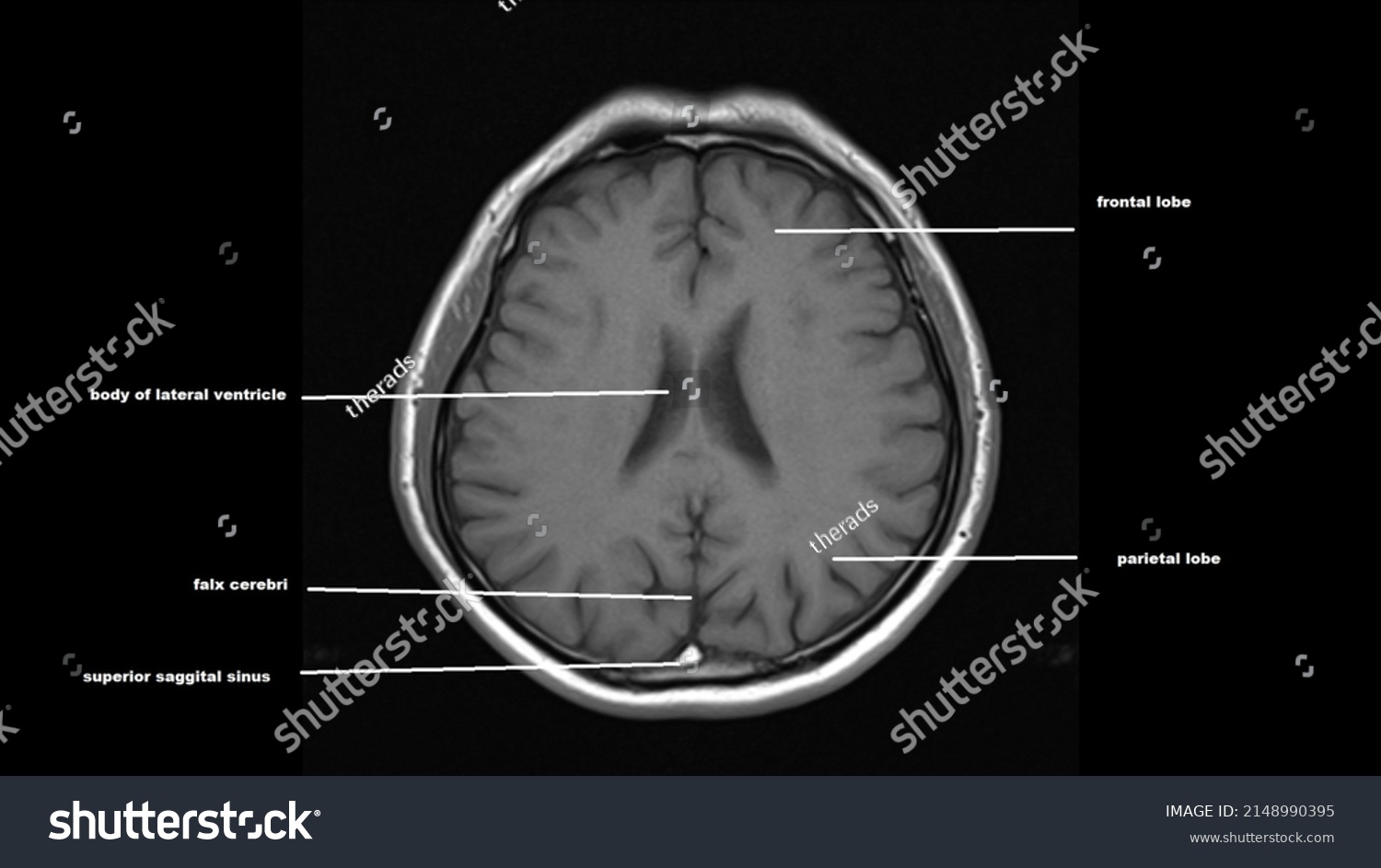 Normal Brain Anatomy Axial T1weighted Mri Stock Photo 2148990395 ... Normal Brain Anatomy Axial T1weighted Mri Stock Photo 2148990395 ...