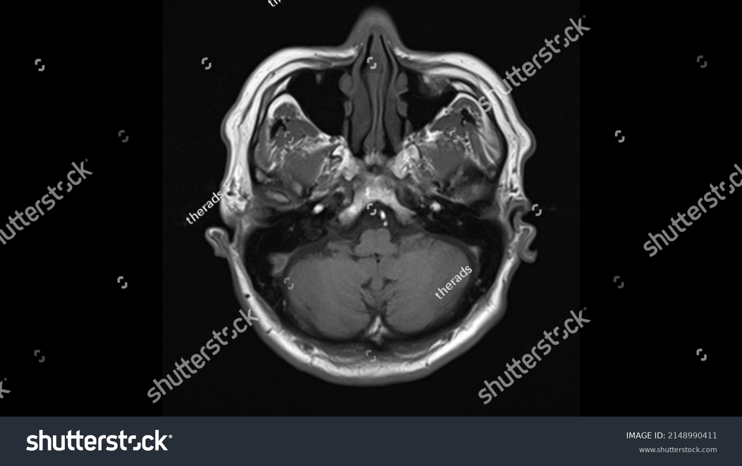 Normal Brain Anatomy Axial T1weighted Mri Stock Photo 2148990411 ... Normal Brain Anatomy Axial T1weighted Mri Stock Photo 2148990411 ...