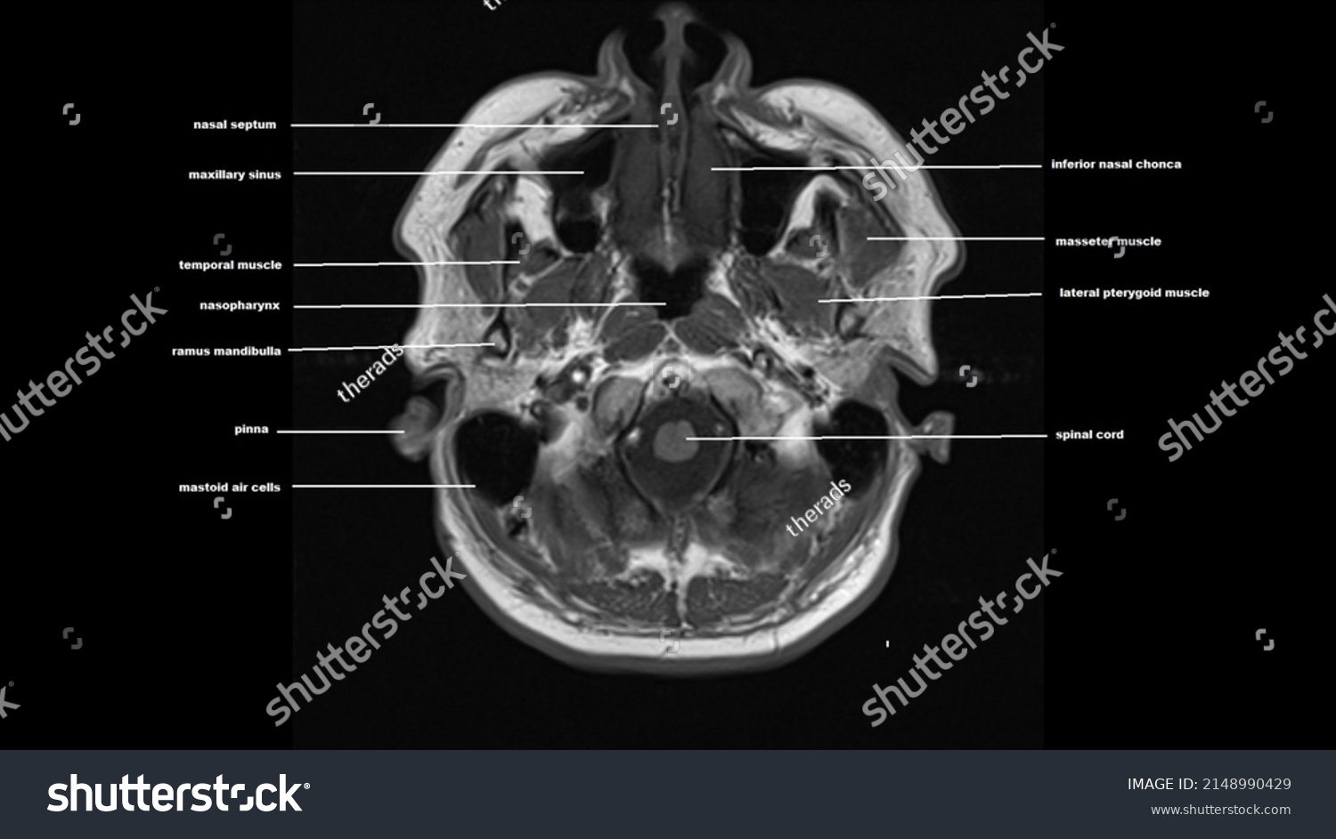 Normal Brain Anatomy Axial T1weighted Mri Stock Photo 2148990429 ... Normal Brain Anatomy Axial T1weighted Mri Stock Photo 2148990429 ...