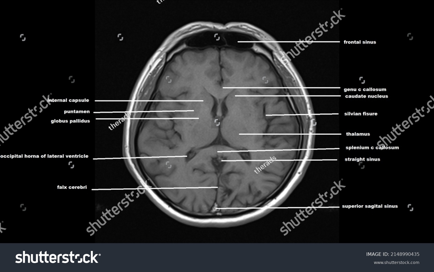Normal Brain Anatomy Axial T1weighted Mri Stock Photo 2148990435 ... Normal Brain Anatomy Axial T1weighted Mri Stock Photo 2148990435 ...