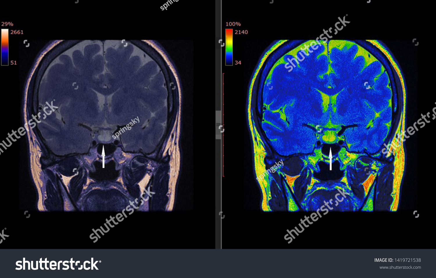 Pituitary Gland Hypophysis Mri Scan Magnetic : illustration de stock ... Pituitary Gland Hypophysis Mri Scan Magnetic : illustration de stock ...