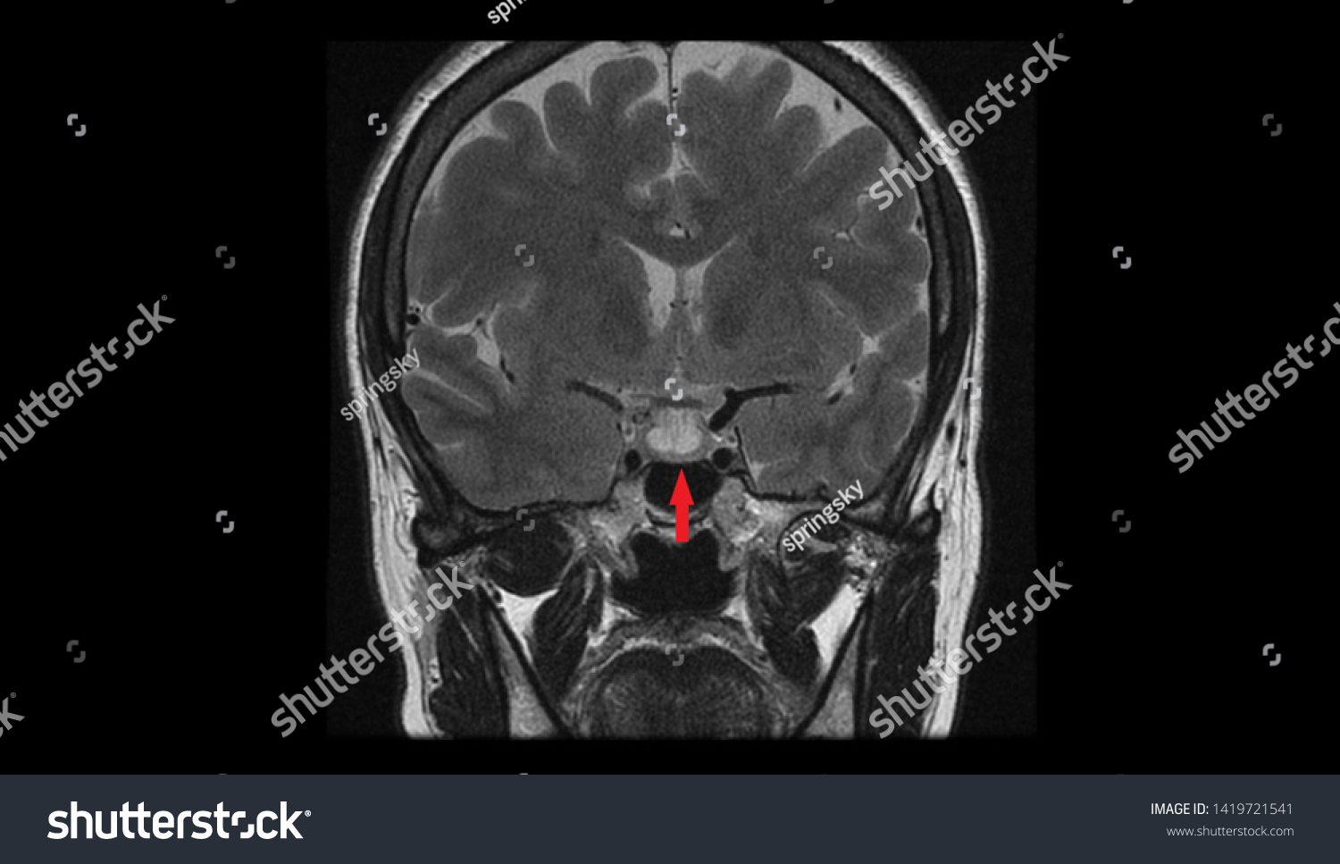 Pituitary Gland Hypophysis Mri Scan Magnetic 库存插图 1419721541 | Shutterstock Pituitary Gland Hypophysis Mri Scan Magnetic 库存插图 1419721541 | Shutterstock