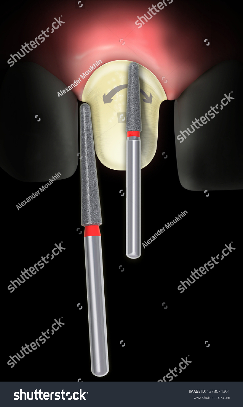 Preparing Shaping Tooth Diamond Dental Burs Stock Illustration ... Preparing Shaping Tooth Diamond Dental Burs Stock Illustration ...