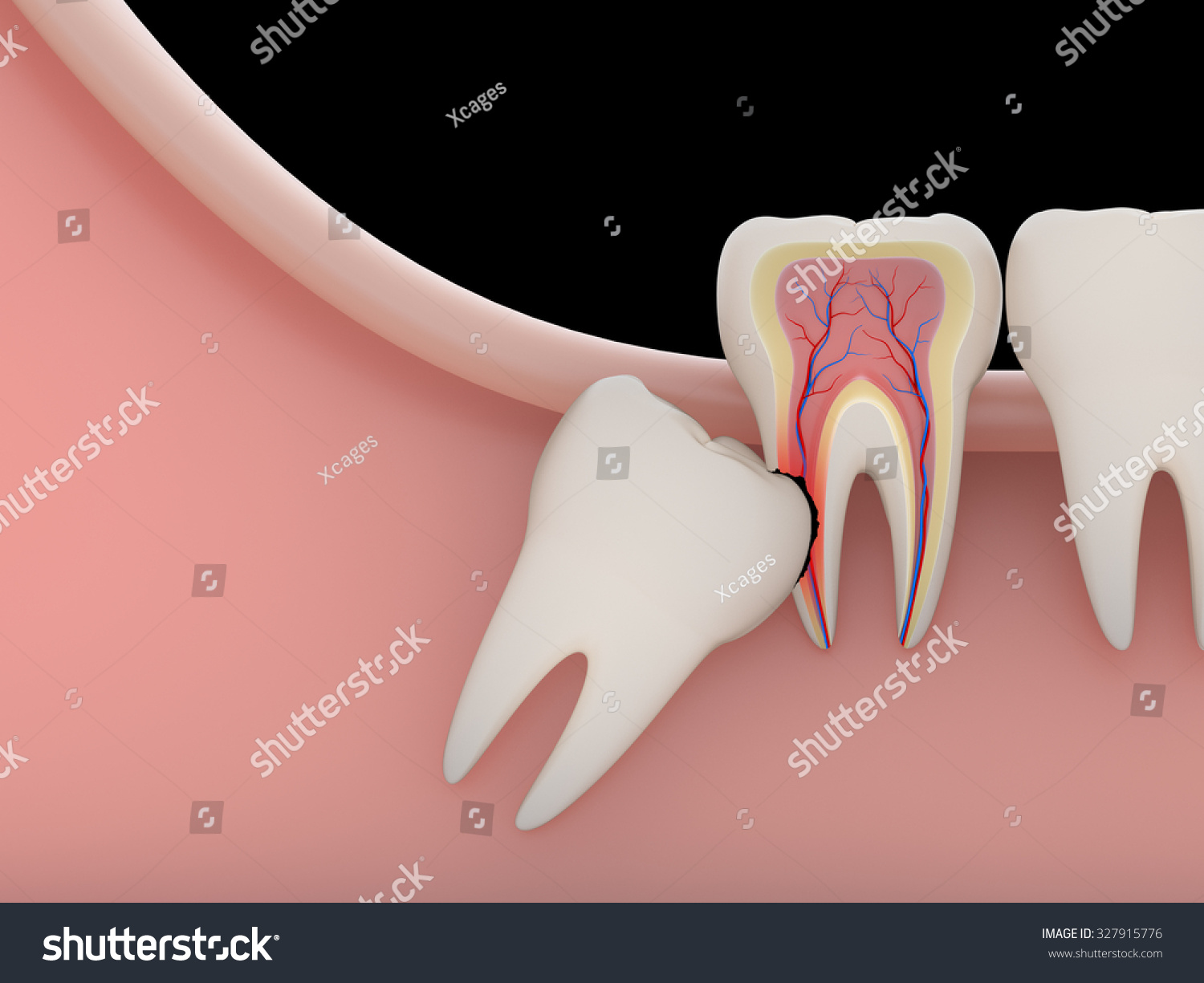 Problems Caused By Impacted Wisdom Teeth Include.Erosion Cavity ...