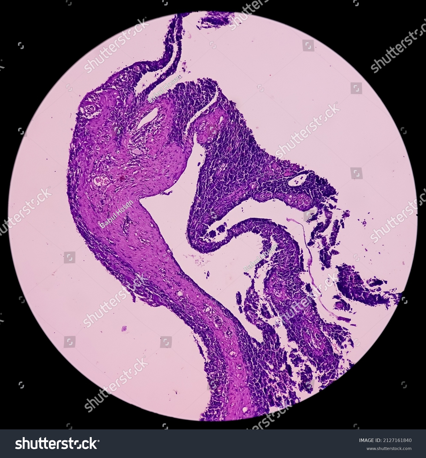 Scapula Cancer Synovial Sarcoma Monophasic Show Stock Photo 2127161840 ... Scapula Cancer Synovial Sarcoma Monophasic Show Stock Photo 2127161840 ...