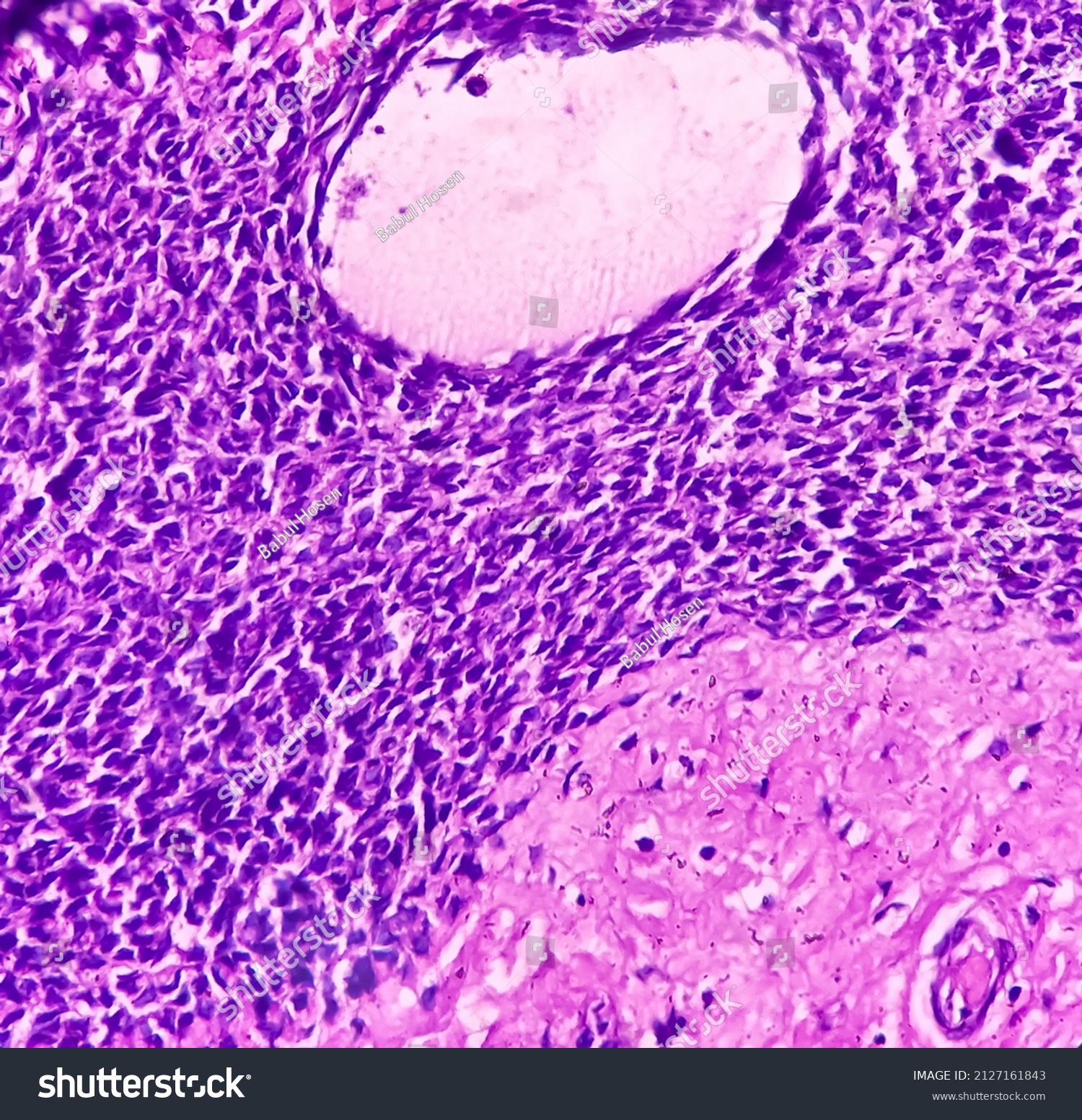 Scapula Cancer Synovial Sarcoma Monophasic Show Stock Photo (Edit Now ... Scapula Cancer Synovial Sarcoma Monophasic Show Stock Photo (Edit Now ...
