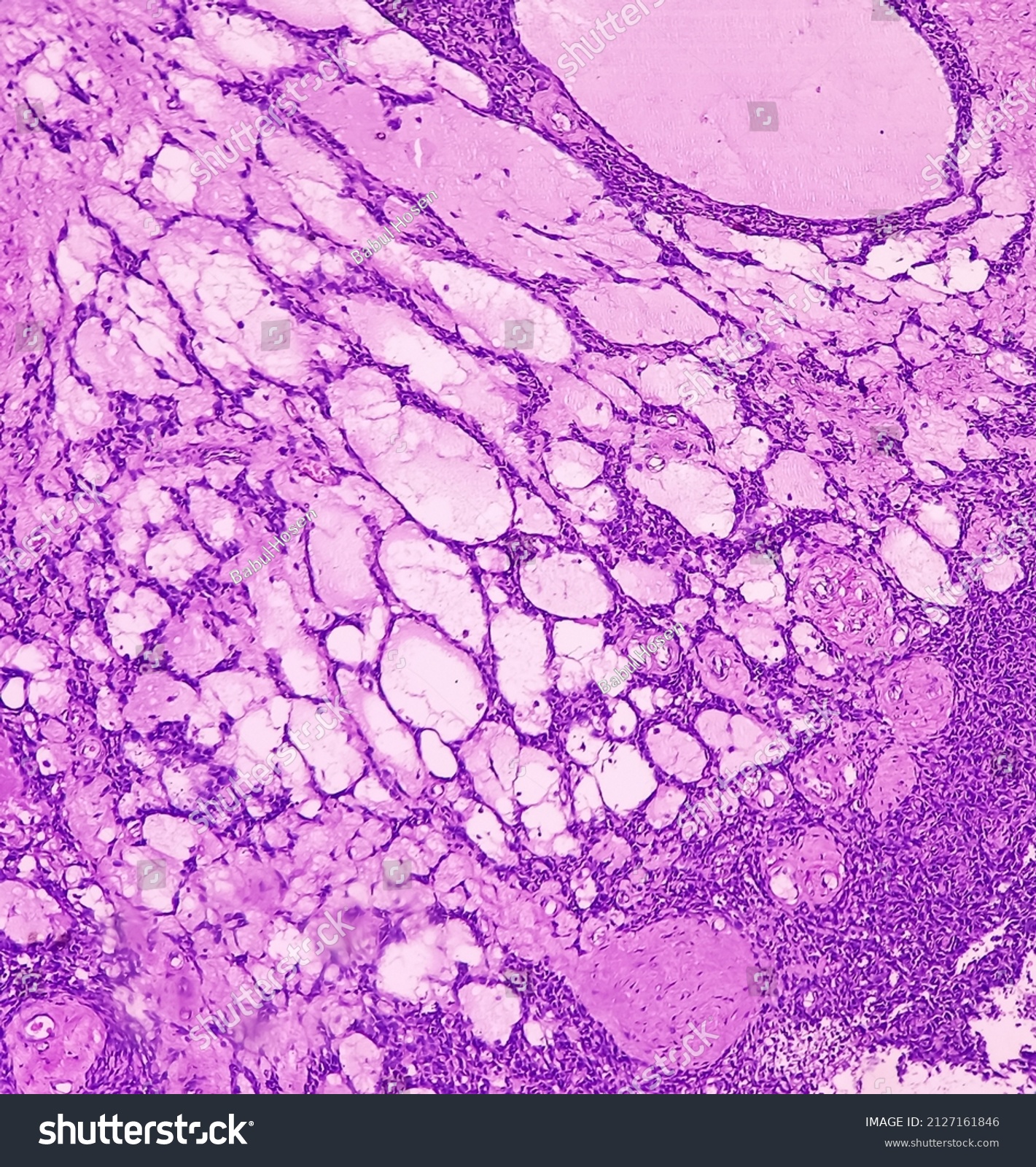 Scapula Cancer Synovial Sarcoma Monophasic Show Stock Photo (Edit Now ... Scapula Cancer Synovial Sarcoma Monophasic Show Stock Photo (Edit Now ...