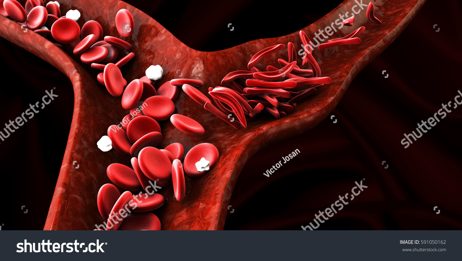 Sickle Cell Anemia Showing Blood Vessel Stock Illustration 591050162 ... Sickle Cell Anemia Showing Blood Vessel Stock Illustration 591050162 ...