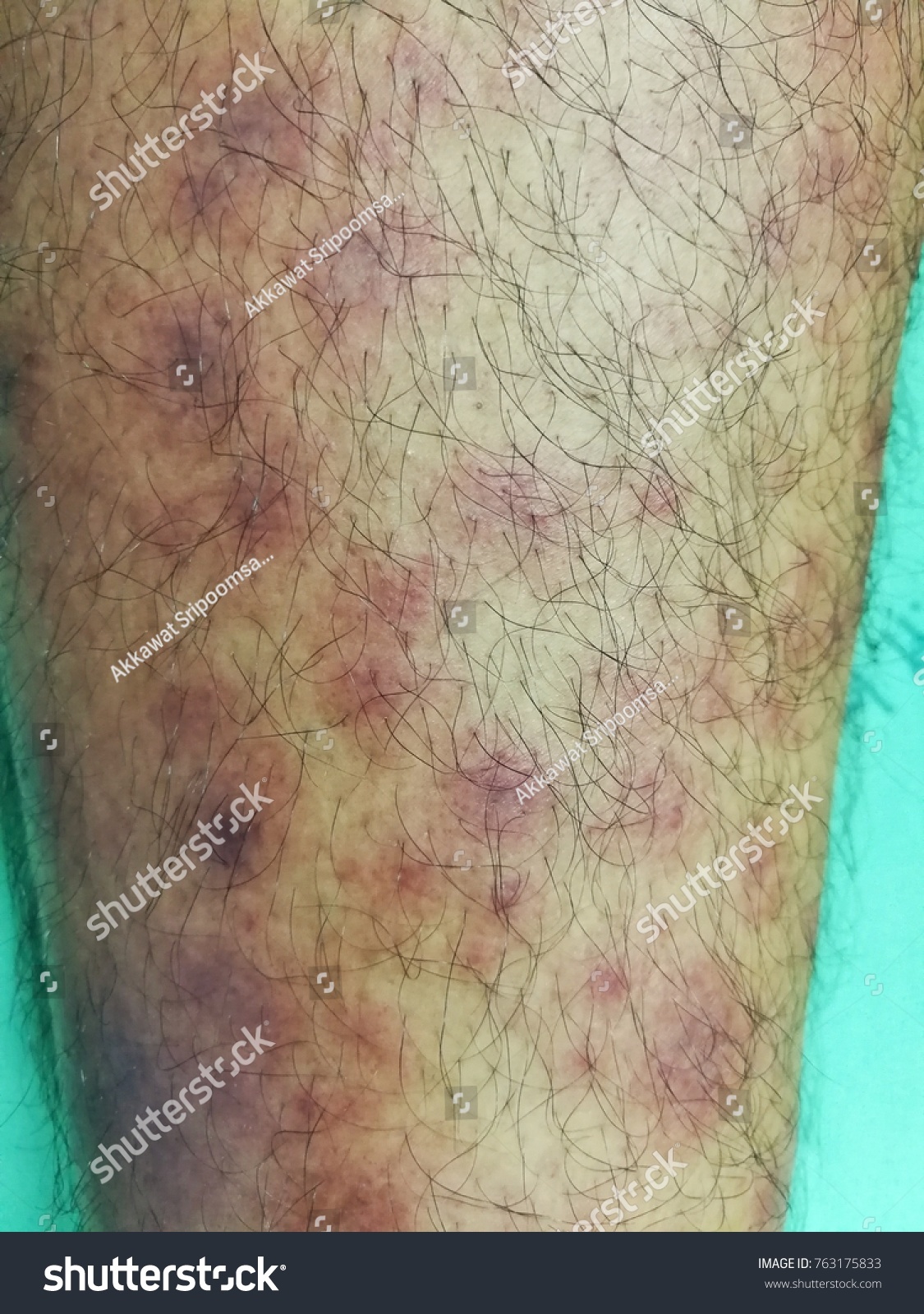 Skin Disease Lesion Ecchymosis Vasculitis Foto Stok 763175833 Shutterstock