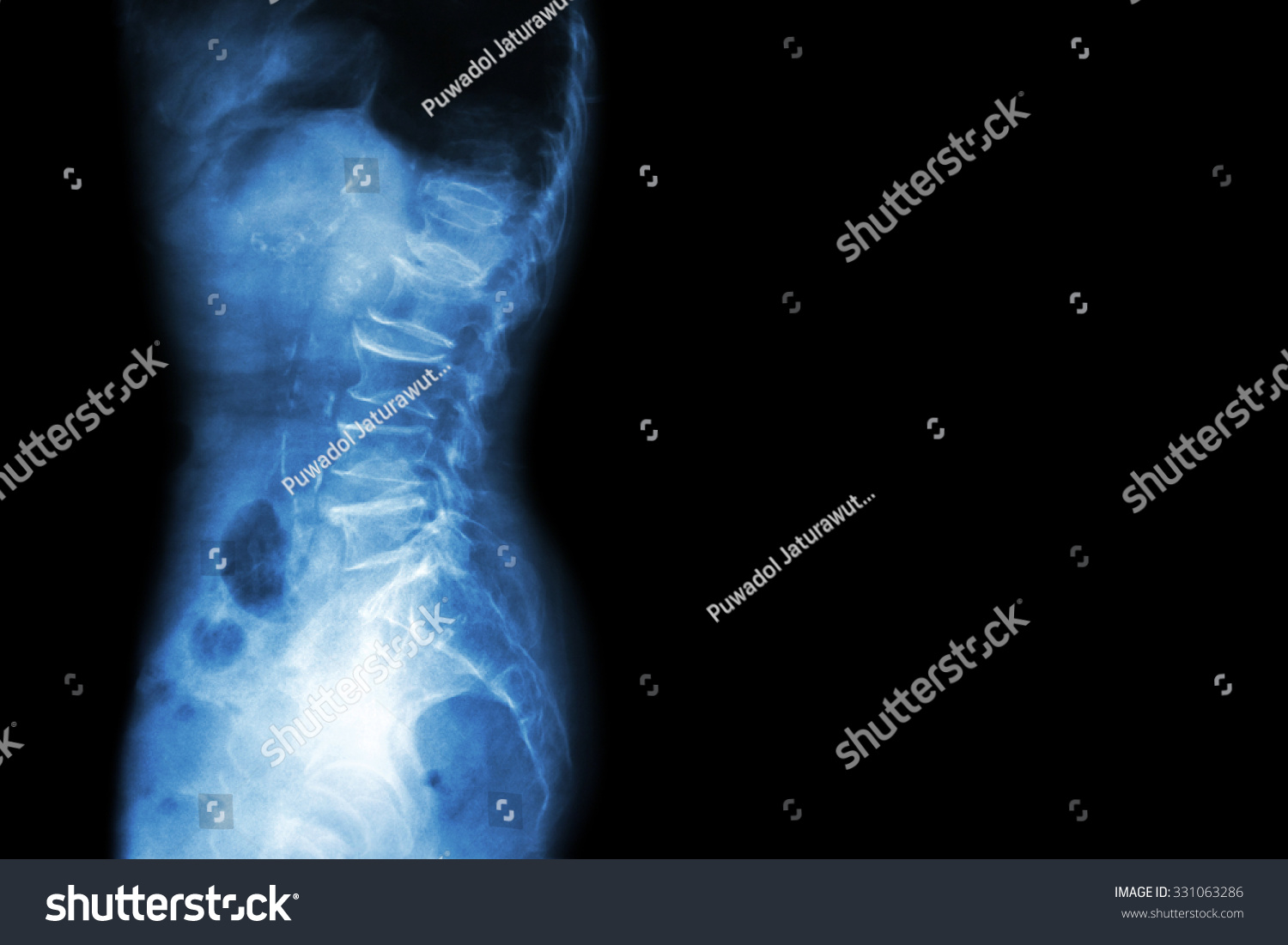 Spondylosis Spondylolisthesis Film Xray Lumbo Sacral Stock Photo (Edit ...