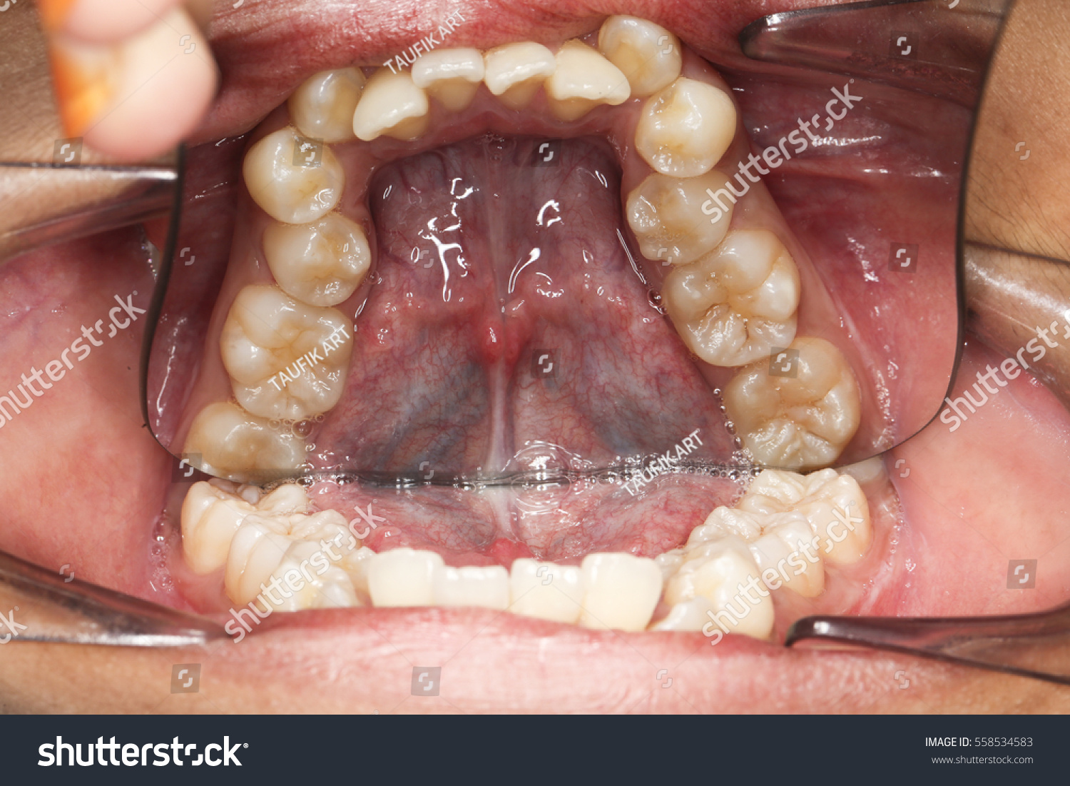 Teeth Checking Before Braces Operation Done Stock Photo (Edit Now ...